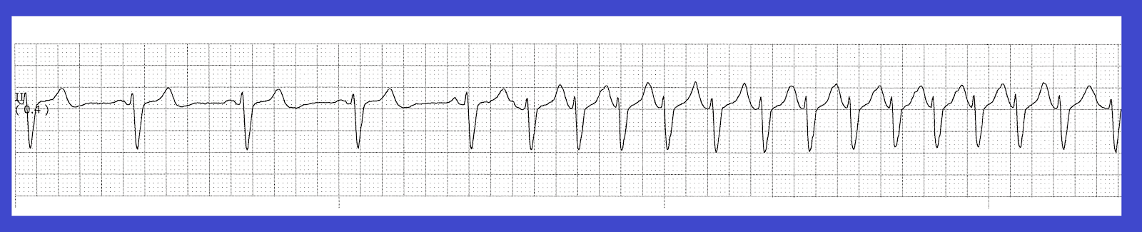 EKG Rhythm Quiz 239