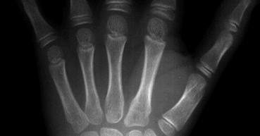 The Quest for Height: Grow Taller | Increase Height | Bone Size: Case(s ...