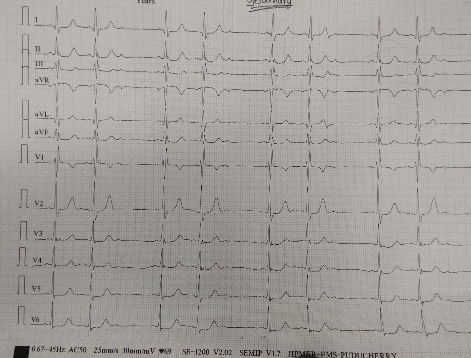Cardiology window: Hyperkalemia induced high grade AV block
