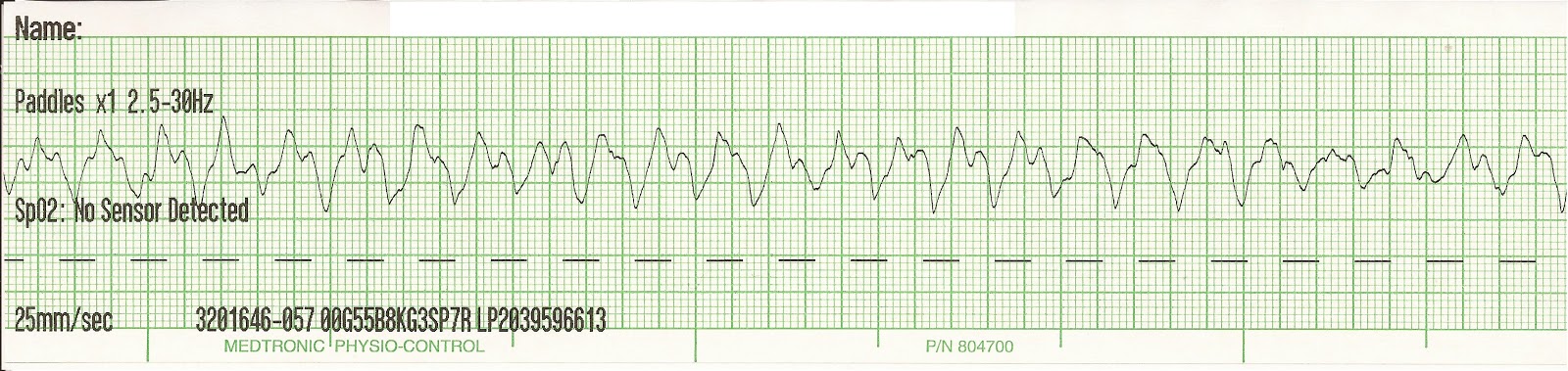 Pediatric cardiac arrest: PEA