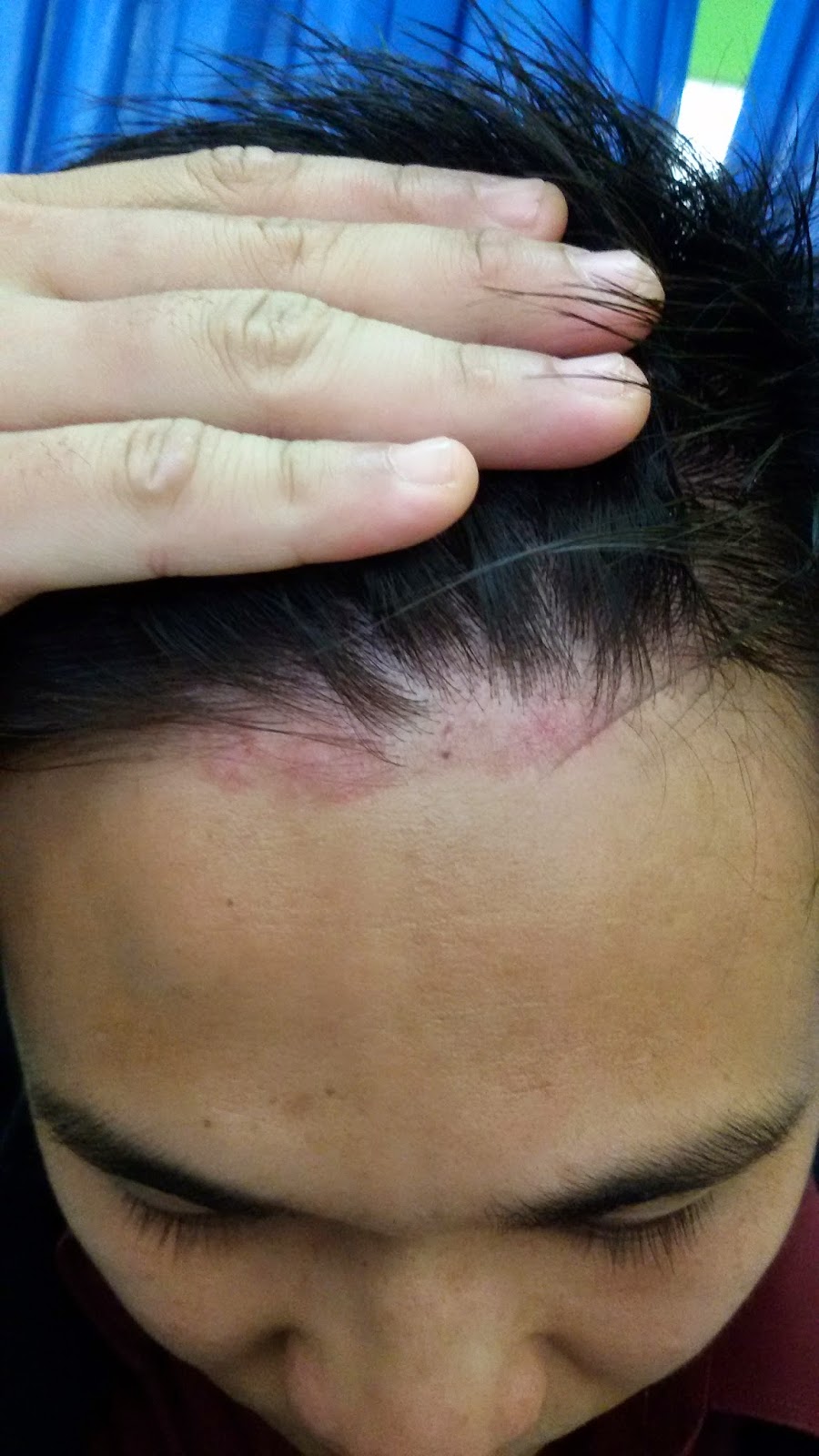 NURHOLIS MEDICAL ARTICLE: DERMATITIS SEBOROIK