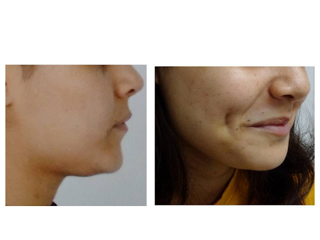 DR. ASHISH GUPTA: HIGHLIGHT YOUR SMILE WITH DIMPLES