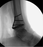 Case of the Month: Fracture cases at Harborview Medical Center ...