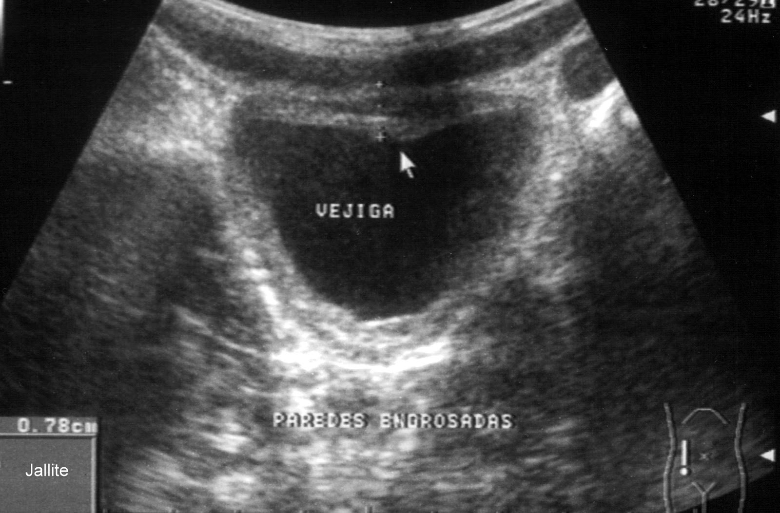 Cistitis Intersticial