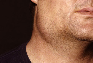 DR. NELSON MENEGHELLO ENDOCRINOLOGIA e CLÍNICA MÉDICA : CAXUMBA (PAPEIRA)