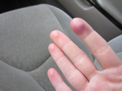 the essence: Broken Finger
