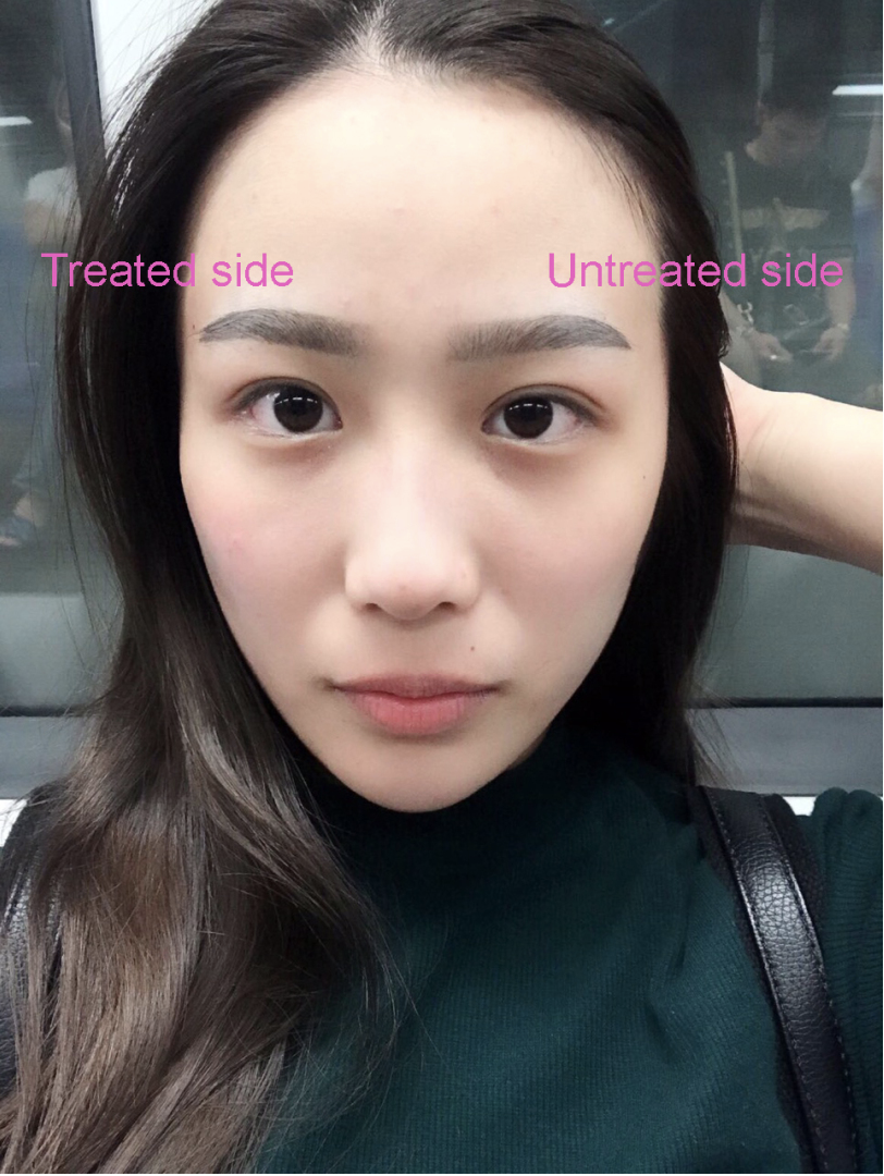 5 Reasons To Start Fillers in Your 30s - The Skin Radar