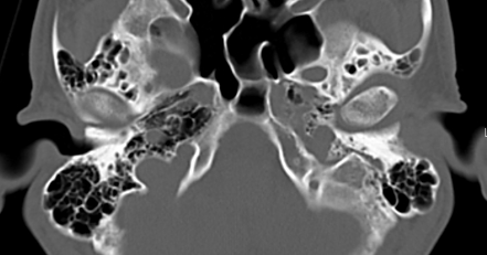 El Baúl Radiológico: HIPERNEUMATIZACIÓN DE LOS HUESOS TEMPORALES Y DE ...