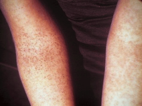 Public Health Resources: What's a Tourniquet Test? How is it done?