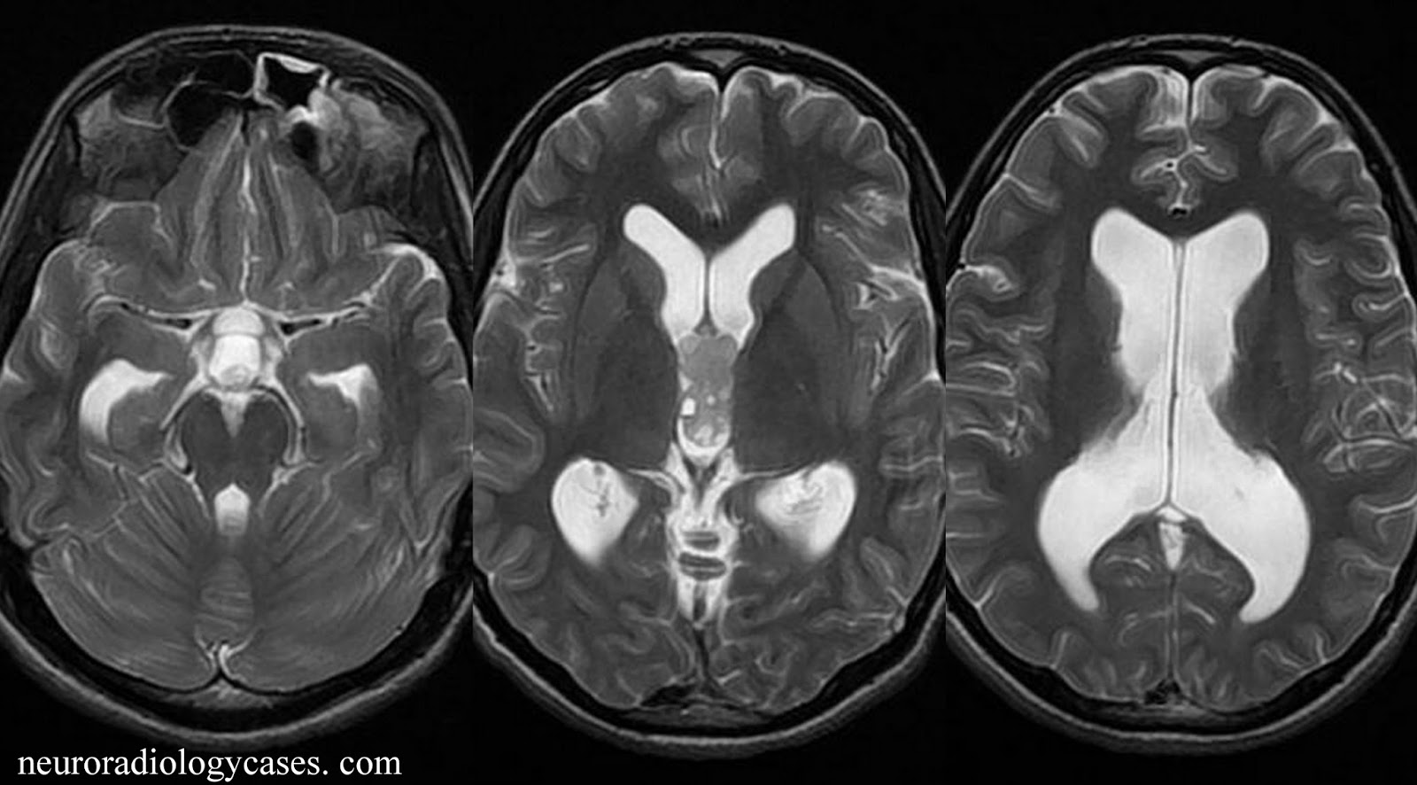 Dr Balaji Anvekar FRCR: CSF shunt imaging