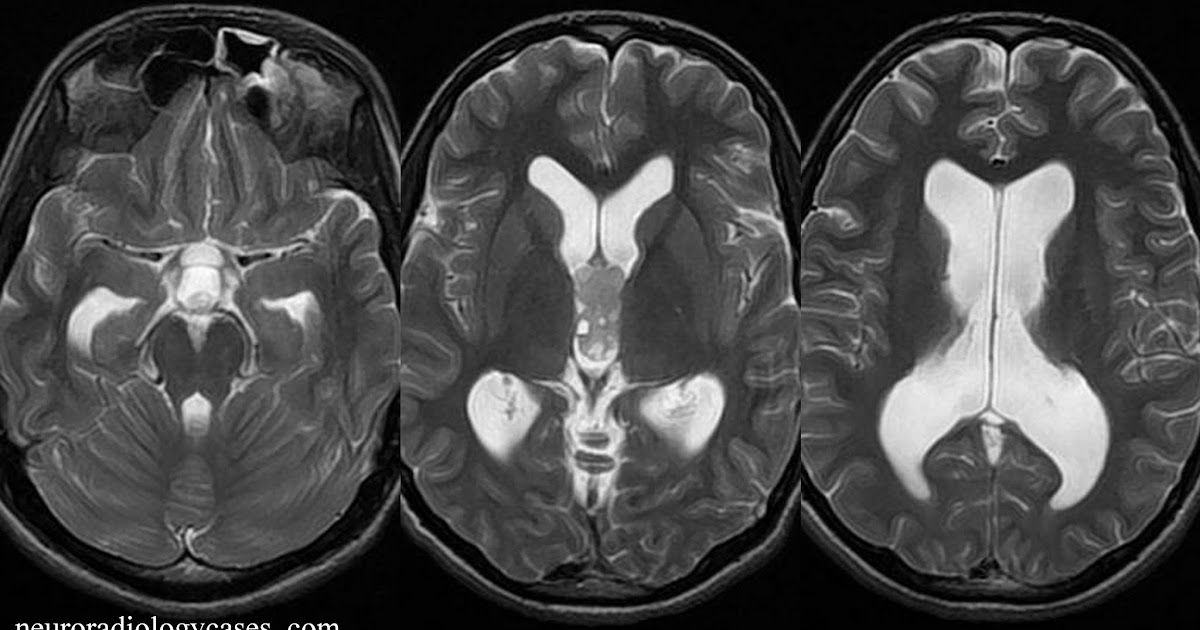Dr Balaji Anvekar FRCR: CSF shunt imaging