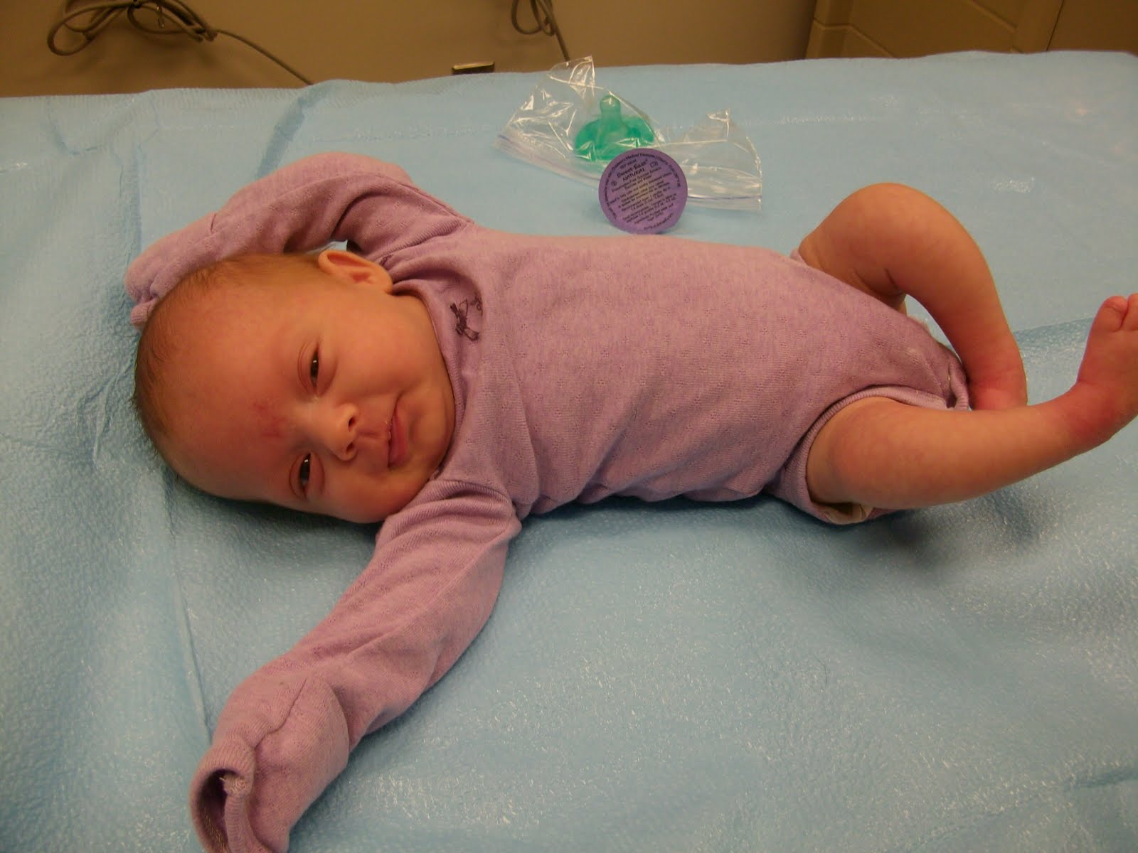 Rachel's Journey with Spina Bifida: 8 weeks old and cast changes