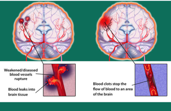 How To Know If We Are Having A Stroke? This Information Can Save Your ...