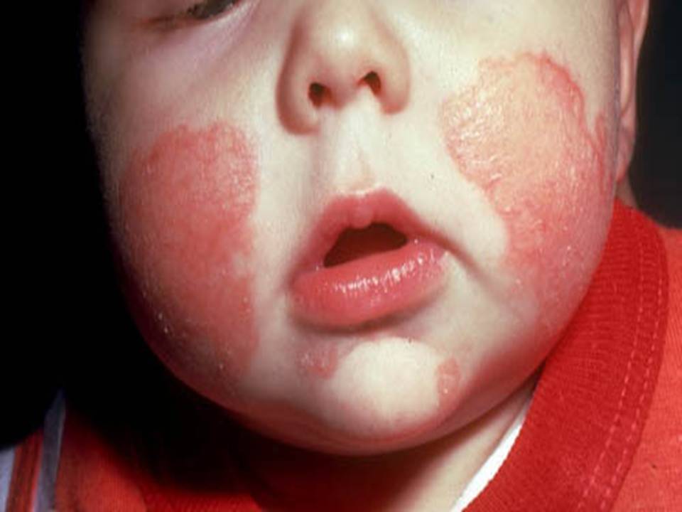Dermatitis atópica