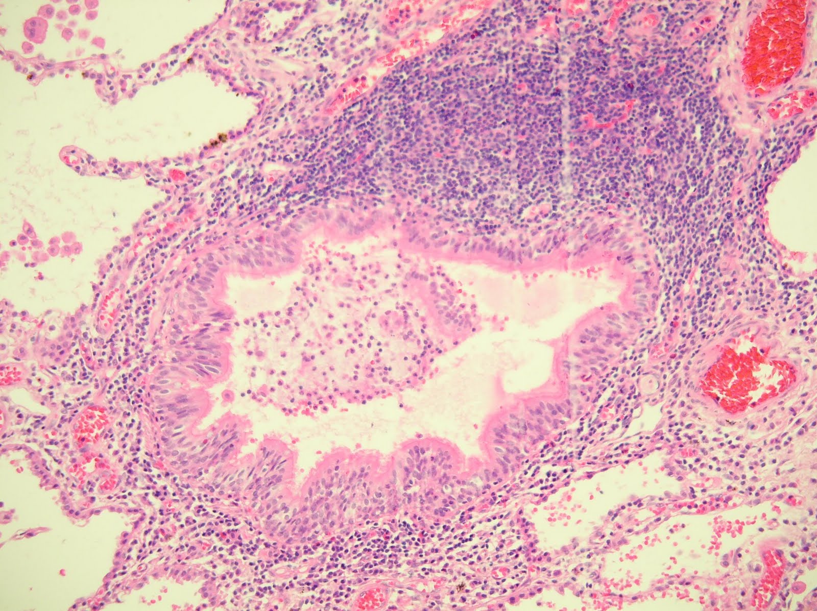 Transudat Exudat | [ HeaLthy Choise for yOUr Life ]