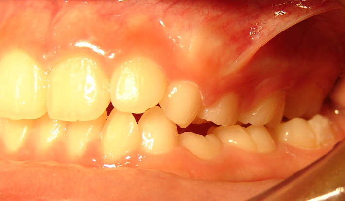 Zona Ortodoncia: Mordida cruzada posterior