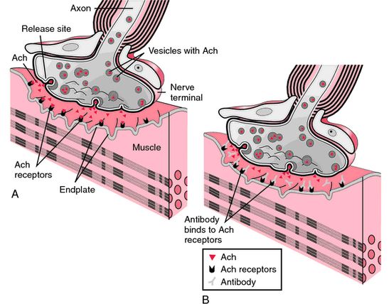 Pulmonary function test for myasthenia gravis |Genetic Engineering Info