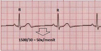 Cara cepat membaca Elektrokardiogram (EKG) | SholehShare