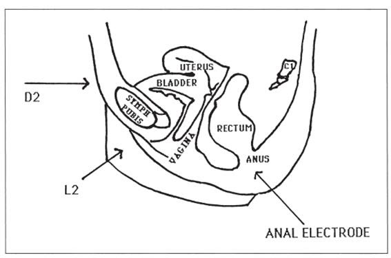 Pelvic Floor Interferential Therapy: Electrode Placement