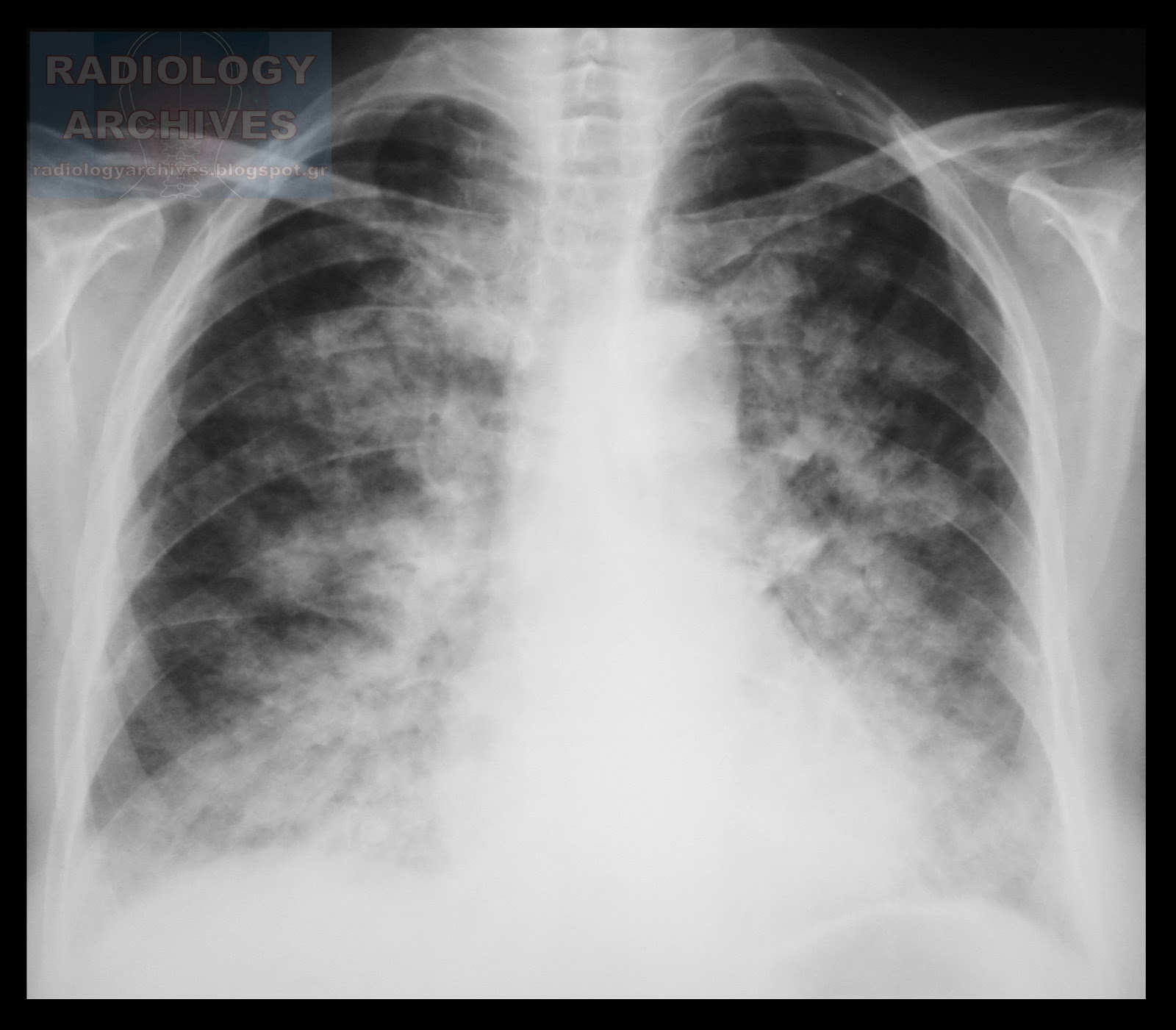 Radiology Archives: Πνευμονικό Οίδημα