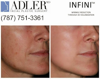 Rejuvenecimiento con Infini en Adler Facial |Levantamiento Facial ...