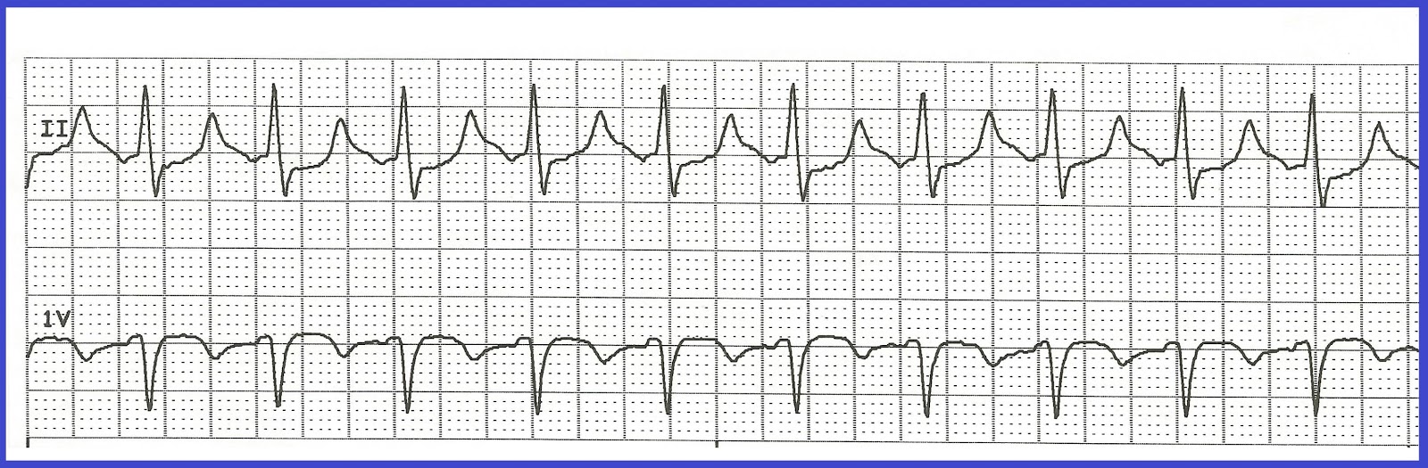 EKG Rhythm Strip Quiz 113