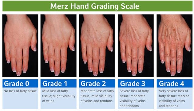 The Dermatology, Laser & Vein Center: Best Hand Rejuvenation Options ...