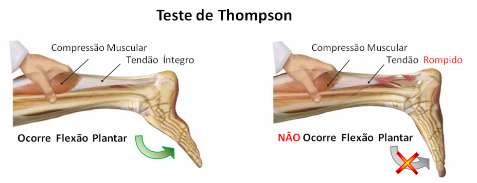 Portfólio Andressa Baron (Fisioterapia): (ORTO) TENDINOPATIA DE AQUILES