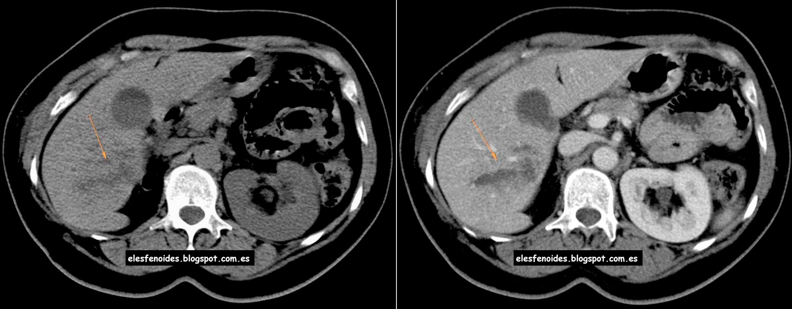El esfenoides: Laceración hepática. 2 imágenes 1 caso.