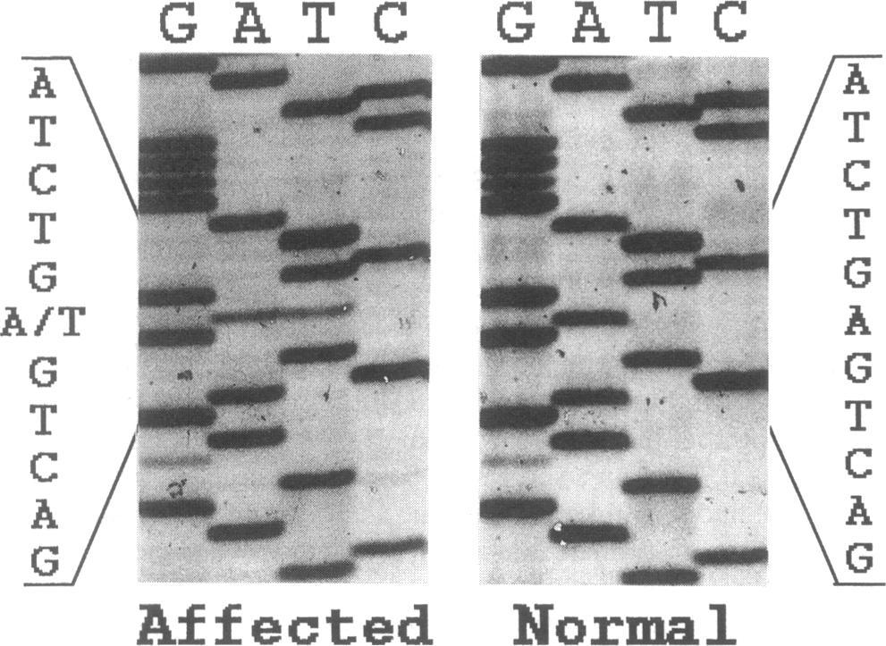 Fibrinogen Amyloidosis: Article Review (1994) - Hereditary Renal ...