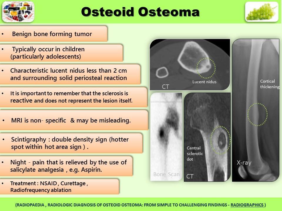 Easy Radiology: Bone tumors