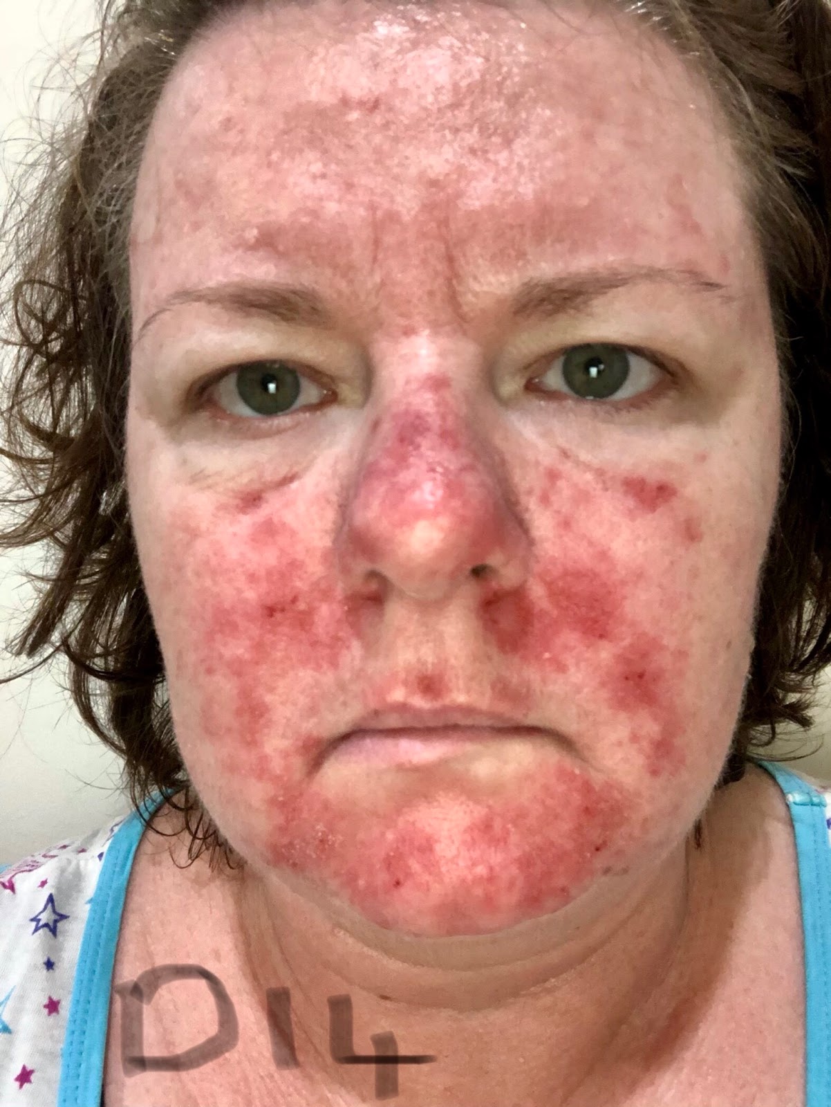 Efudix Treatment November 2018