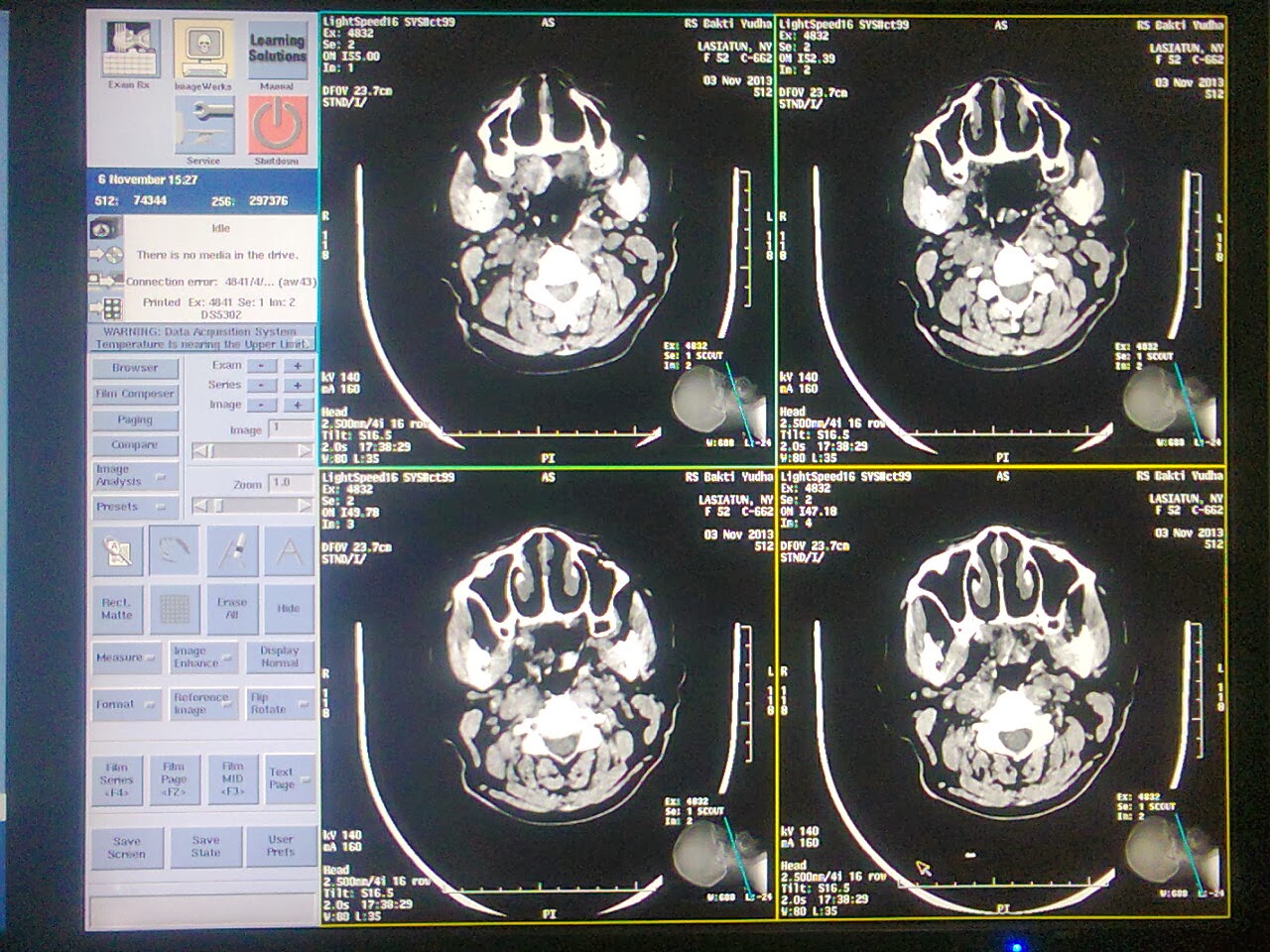 SiMpLe LoVe 'n LiVe: CT Scan (Computed Tomography Scanner)