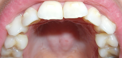 Sneek's Invisalign Treatment: Progress Weeks 27-28