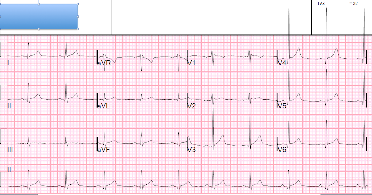 Dr. Smith's ECG Blog: Syncope and a Possible Type 2 Brugada Morphology
