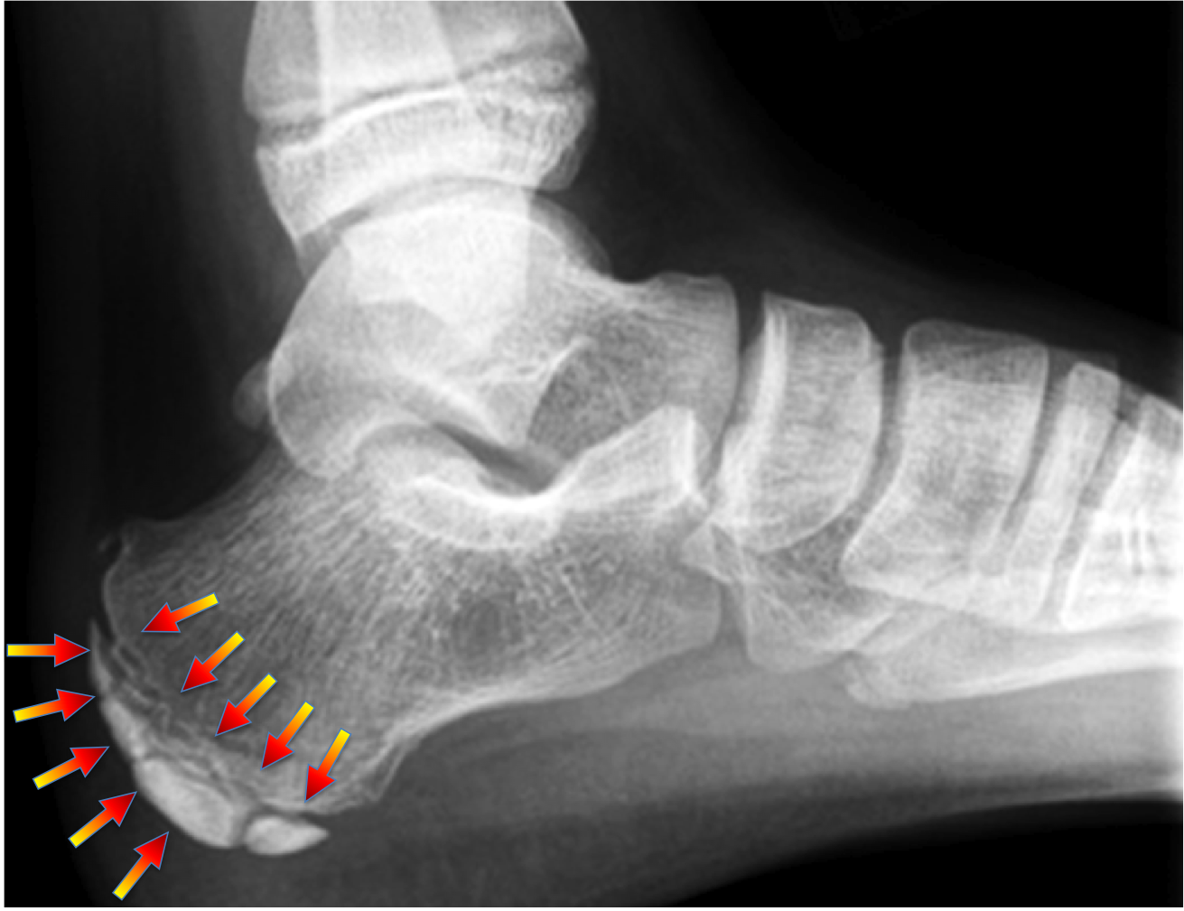 DR. CELSO RIZZI: Apofisite do Calcaneo - Doença de Sever