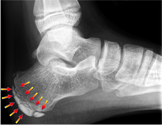 DR. CELSO RIZZI: Apofisite do Calcaneo - Doença de Sever