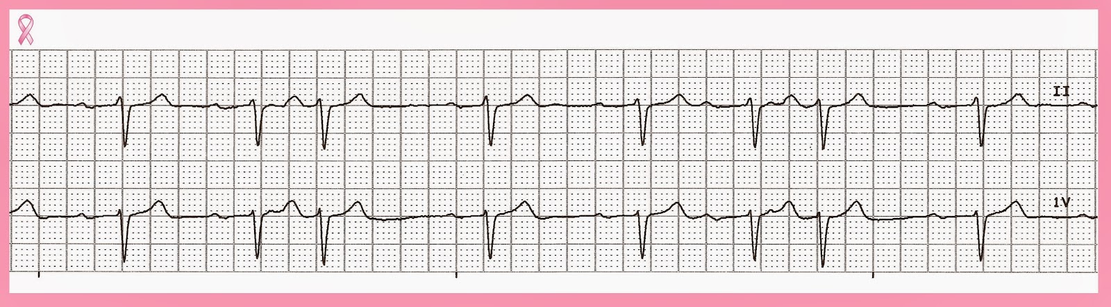Practice EKG Strips 357