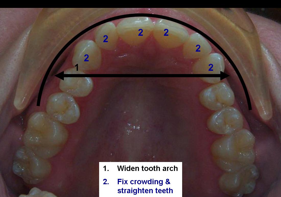 Dr. Keith Harvey: Adult Orthodontics - A Patient's Experience (Post 1)