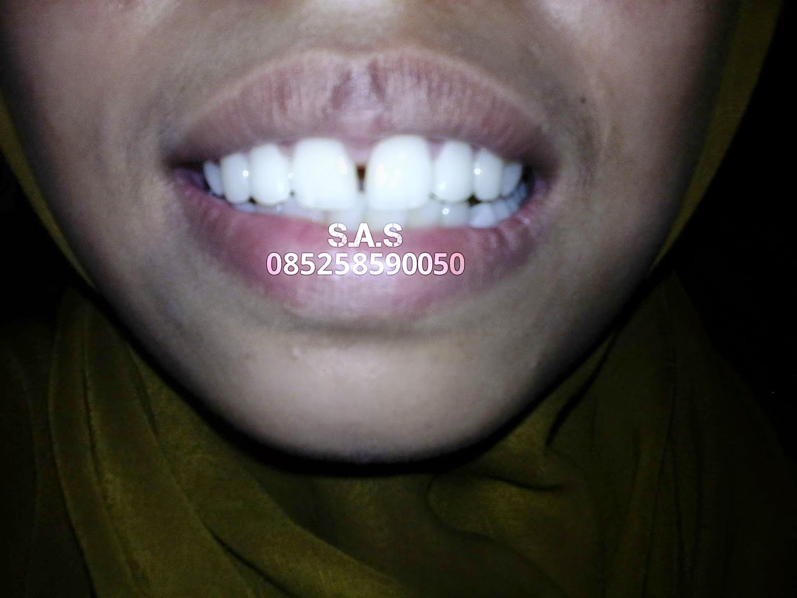 Merapikan Gigi Renggang (Diastema) dan Gigi Tidak Rata Secara Instan ...