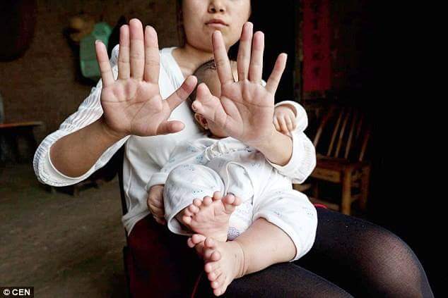 Parents of a Child born with 15 fingers and 16 toes beg for help