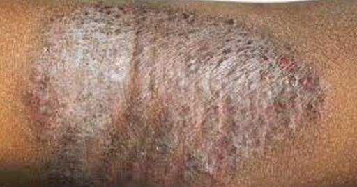 Cara Menghilangkan Bekas Gatal Yang Menghitam Dengan Cepat Dan Bahan ...