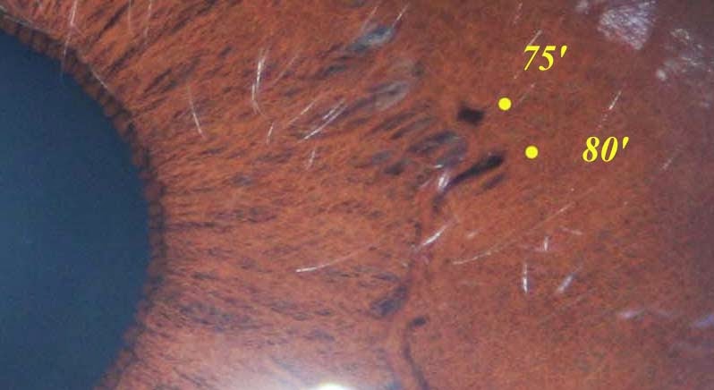Modern & Multidimensional Iridology: Pupil Flatness, Collarette ...