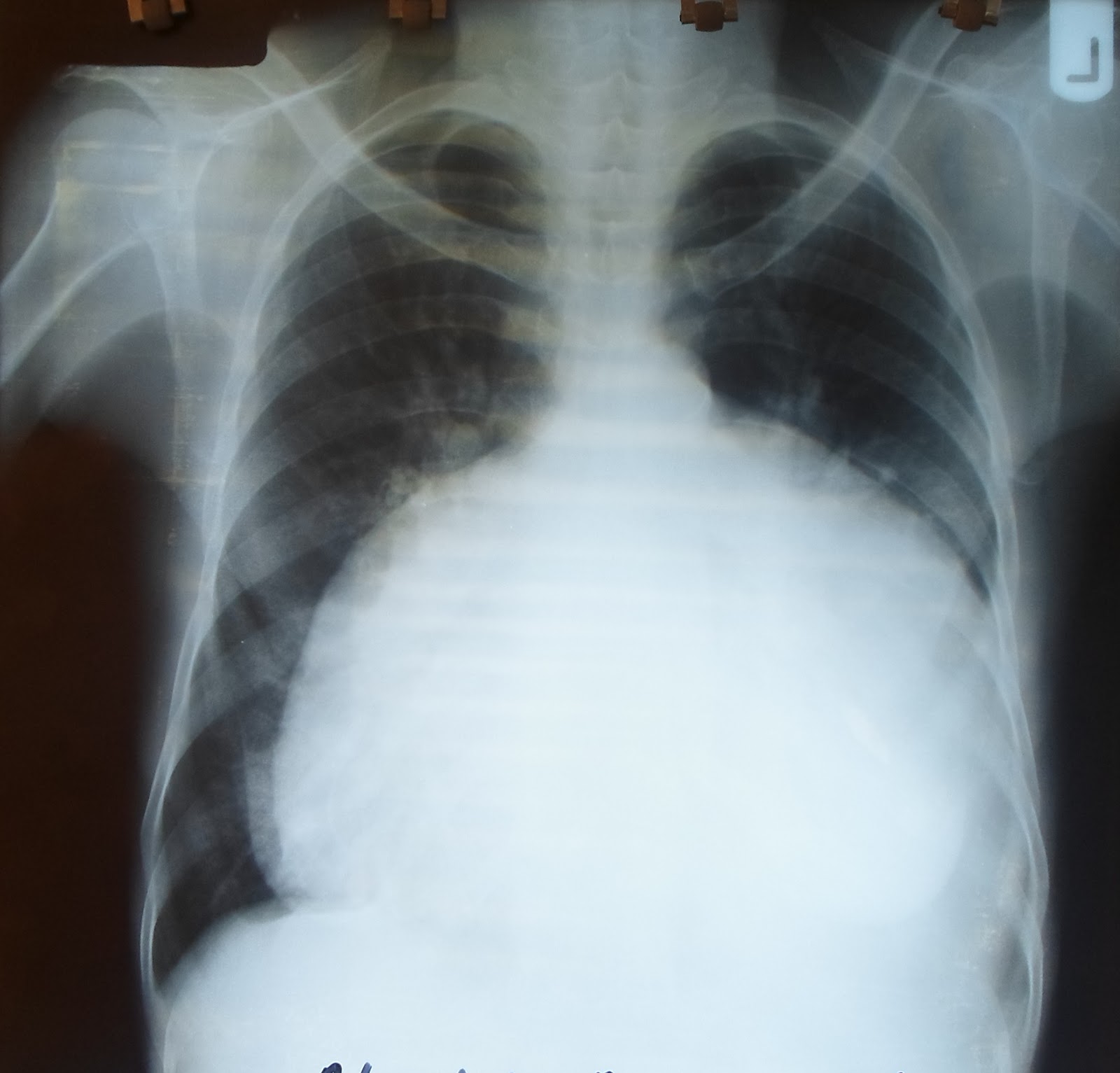 Ohemaa's M.D.: The Woman with the Big Heart: A Case of Cardiac ...