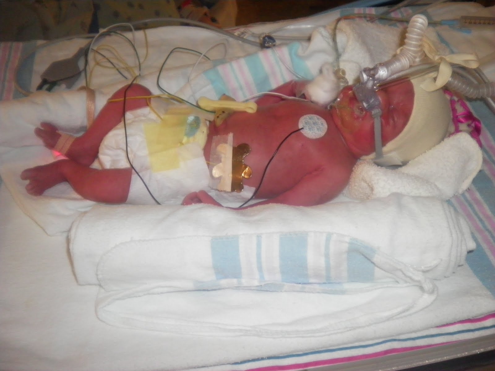 Preemie Prints Information Blog: Common NICU Disorders