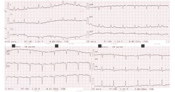 ECG Rhythms: Extreme supraventricular bradycardia