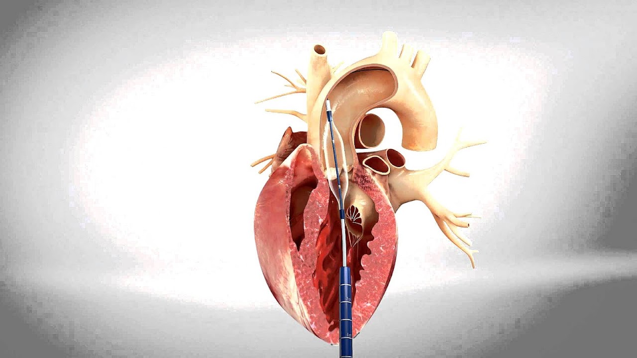 Percutaneous aortic valve replacement Hear - Hear Choices