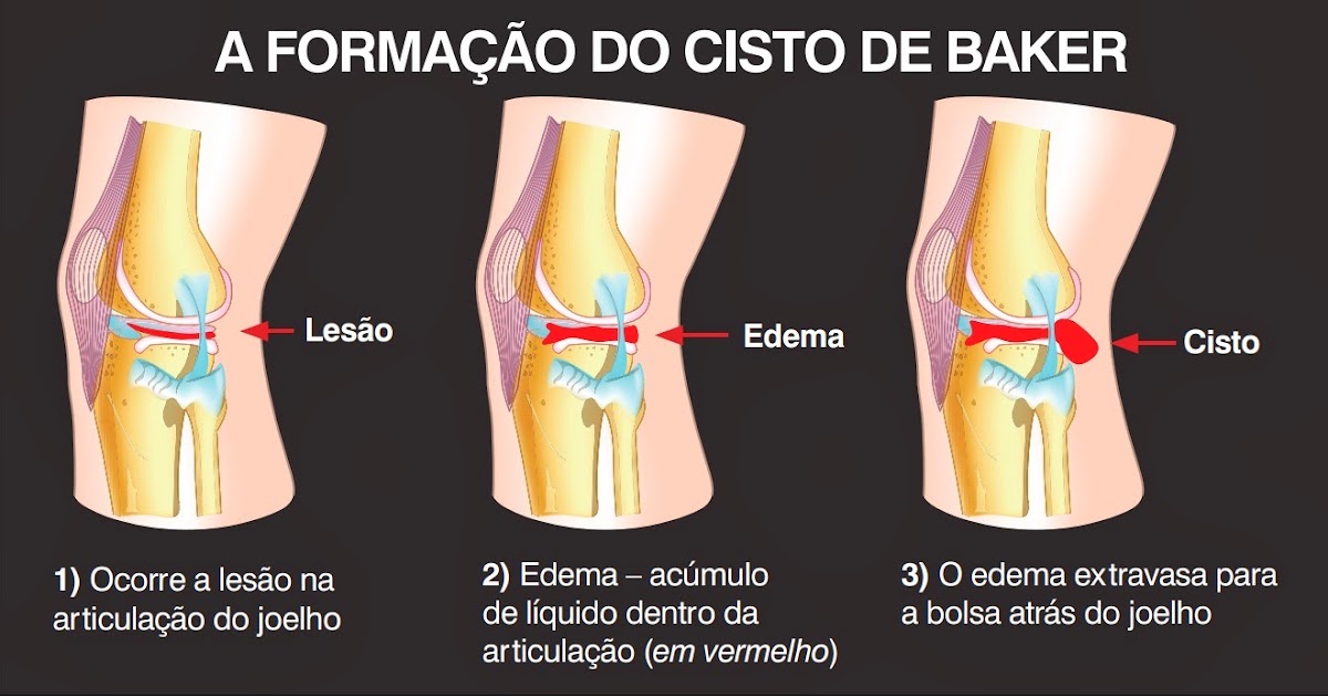 SEMIOBLOG: Diagnóstico Clínico do Cisto de Baker