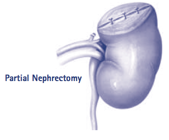 Medical Treatment Pictures-for Better Understanding: Nephrectomy ...
