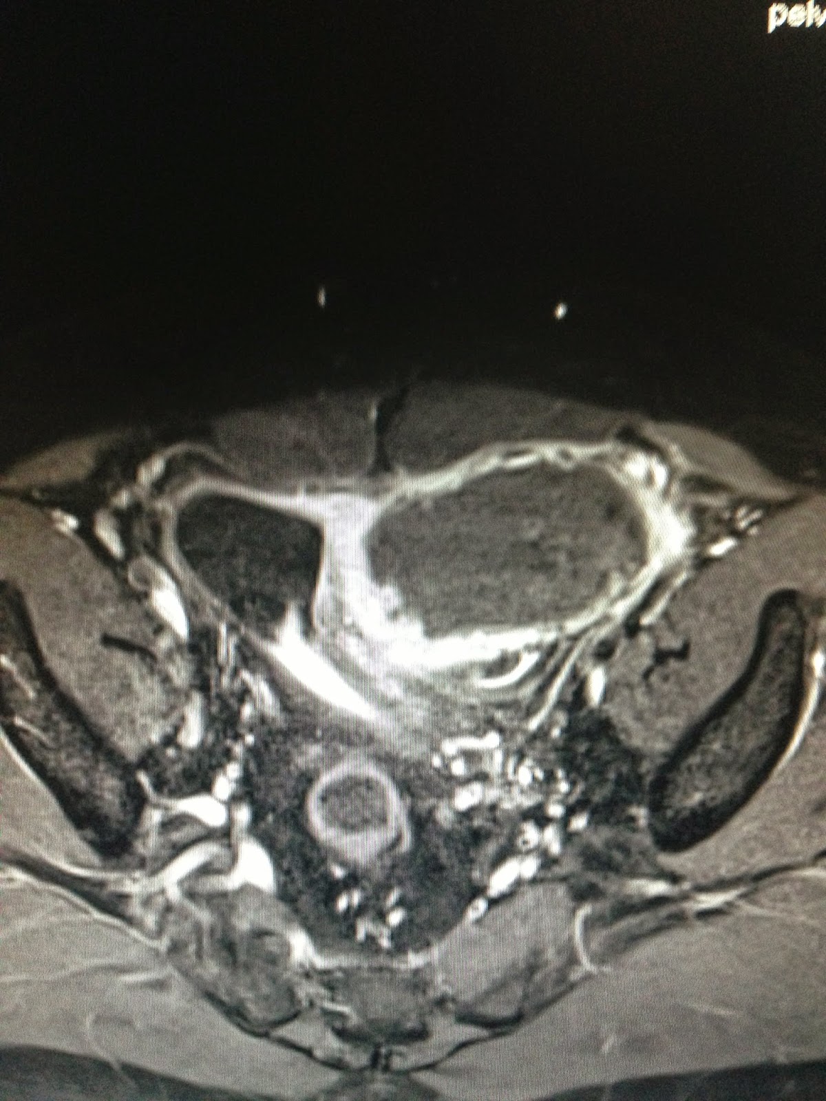 VIETNAMESE MEDIC ULTRASOUND: CASE 282: SUPRAPUBIC MASS, Dr PHAN THANH ...
